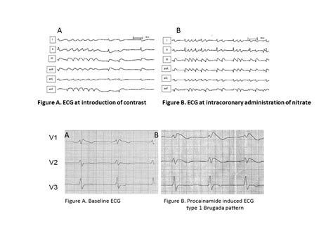 What Diagnostic Algorithm Should Be Performed For Patients With These ECG Changes ResearchGate