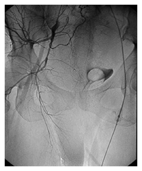 Angiographic Embolization Of A Postpartum Vulvovaginal Hematoma In A