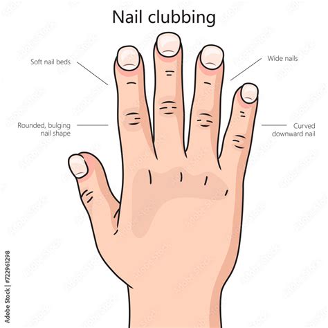 Nail Clubbing Diagram Hand Drawn Schematic Raster Illustration Medical