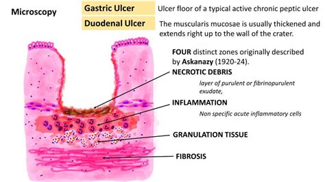 Gastric Vs Duodenal Ulcers Pathology Made Simple