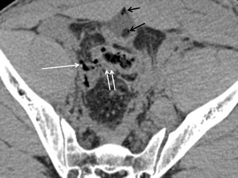 A Ct Scan Of Perforated Bowel In A 26 Year Old Man With Mva Note Download Scientific Diagram