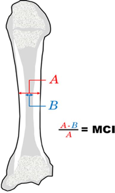 Figure 1 From The 2nd Metacarpal Cortical Index As A Simple Screening Tool For Osteopenia
