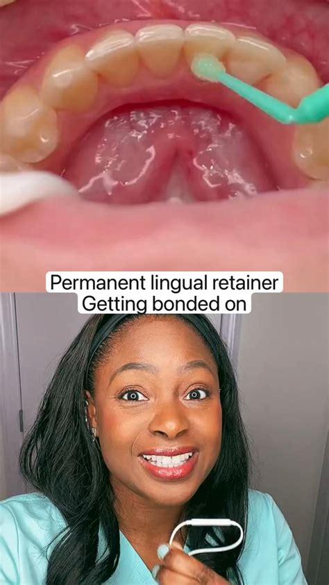Permanent Lingual Retainer Getting Bonded On Healthy Teeth Sensitive Teeth Braces Tips
