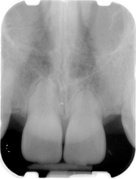 Orthodontic Root Resorption Occlusion Lee Ann Brady DMD S Dental Blog