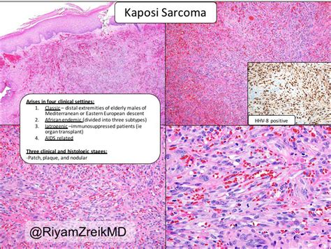 Kaposi Sarcoma Histology