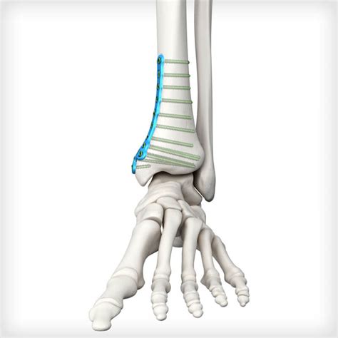 Ankle Medline Medial Distal Tibia Plates