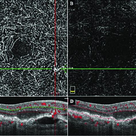 OCTA And OCT B Scan Images Of The DCP And OR Segments At The Onset Of Download Scientific