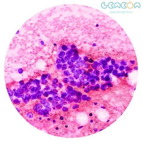 Tumor Derived Autoantibodies Identify Malignant Pulmonary Nodules By Gene On Biotech May