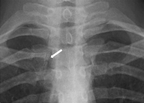 Medial Clavicular Epiphysis Frontal Radiograph Of The Sternoclavicular