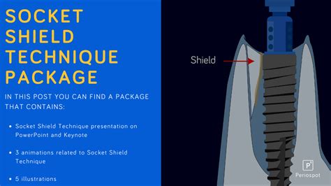 Socket Shield Technique Package Periospot