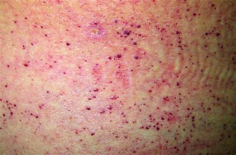 Penyakit Fabry Gejala Penyebab Dan Pengobatan Alodokter