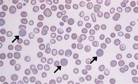 Blood Smear Abnormalities Flashcards Quizlet