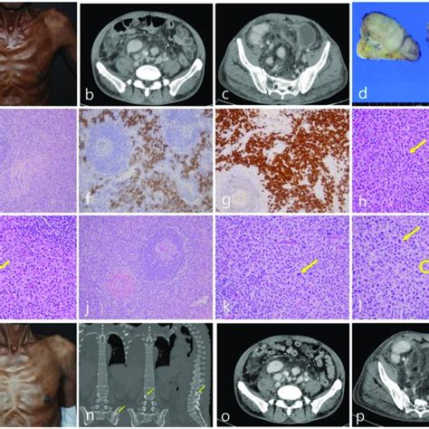 Moderate To Severe Global Hypokinesis Of The Lv On Echocardiogram Lv