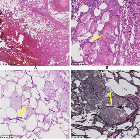 A Histopathological Examination Of Cutaneous Ulcers Shows Dense Dermal
