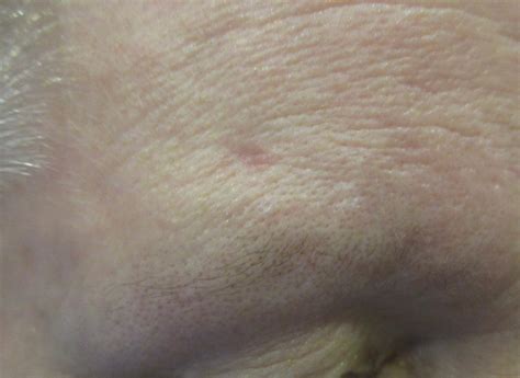 Basal Cell Carcinoma On Forehead Bcc Image Example Mr Tehrani