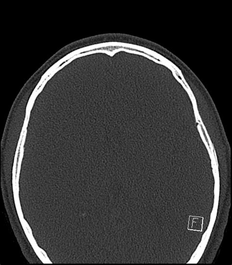 Trochlear Apparatus Calcification No Fb