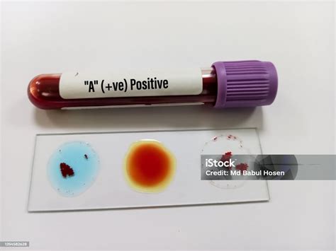 Photo Libre De Droit De Test De Groupe Sanguin Par Méthode Dagglutination Par Lames Avec