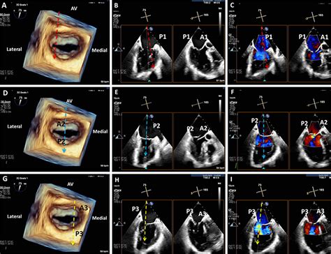 Mitral Valve Teer In The Uk What You Need To Know As Teer Becomes Routinely Available In The Nhs