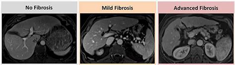 Using Qualitative Descriptors Of Chronic Liver Disease On Mri A