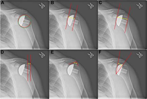 The Effect Of Lateralization On Clinical Outcomes After Anatomic Total