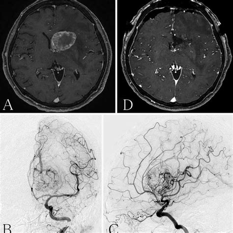Preoperative Gadolinium Enhanced T1 Weighted Mri Image Shows That The