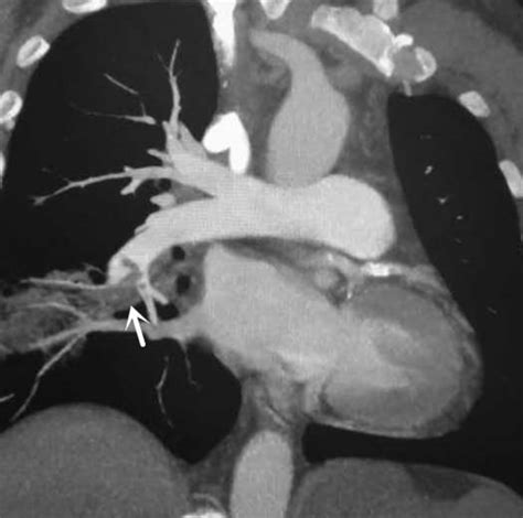 Pulmonary Embolism Pe Demonstrated By Computed Tomography Ct Download Scientific Diagram