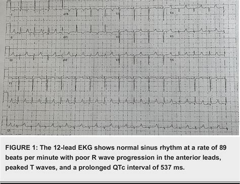 Figure 1 From Hyperkalemia Causing Inappropriate Subcutaneous