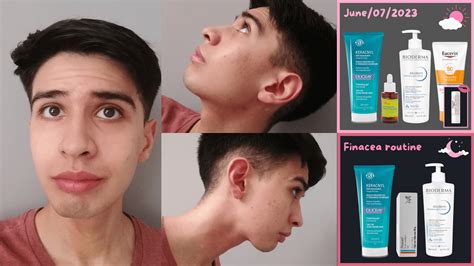 Beforeandafter My 15 Year Skincare Journey The Battle Against Acne