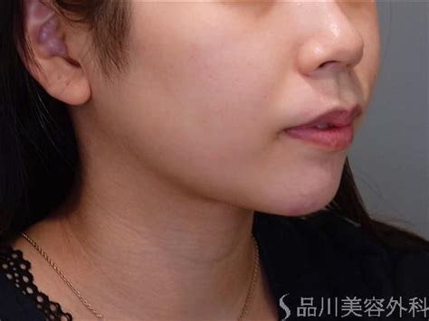 渋谷院長谷部医師による美肌アモーレリフト（ダイヤモンド） スキンクリニック渋谷院 品川美容外科 症例サイト