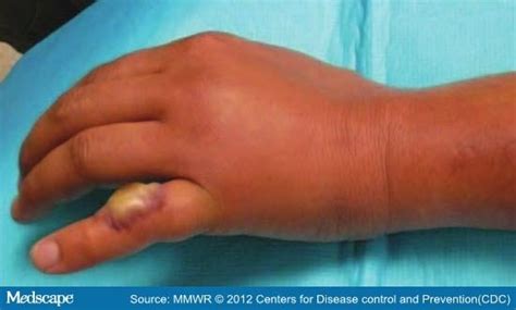 Orf Hand Infection The Appearance Of The Third Patients Lesion On
