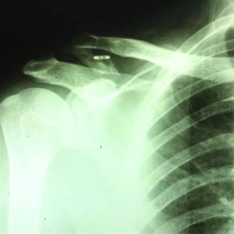Pdf Short Term Clinical Outcomes Of Hook Plate Compared To Continuous Loop Double Endobutton