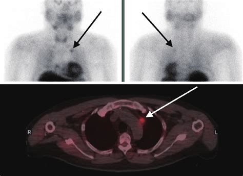 Sestamibi Parathyroid Scan Showing Uptake In A Mediastinal Ectopic