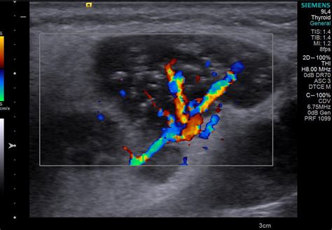 Brown Tumour And Its Differential Diagnosis Challenges In Radiological Evaluation Eurorad