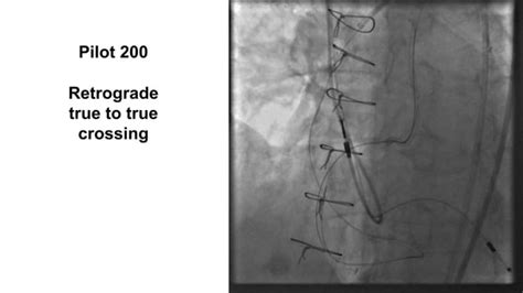 Cto In Post Cabg Patients Ppt