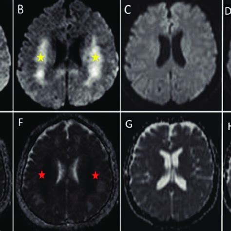 34 Year Old Female Images A Acute Diffusion Restriction In The Middle
