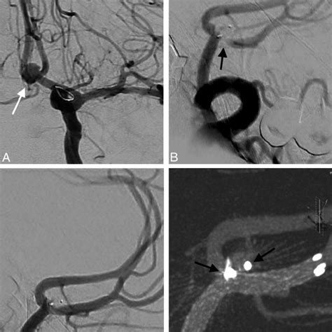 Web Occlusion Scale Grade 0 Indicates Complete Occlusion Grade 0 Ј Is Download Scientific