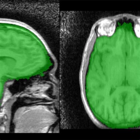 Stage 1 Segmentation For Macaque Download Scientific Diagram