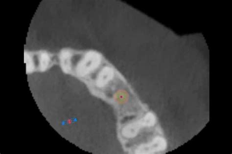Reconstruction Of A Single Tooth Defect With The Shell Technique