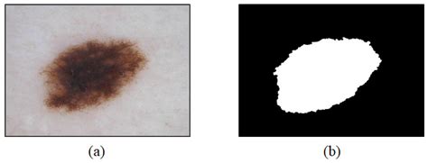 Computer Aided Diagnosis Algorithm For Classification Of Malignant Melanoma Using Deep Neural