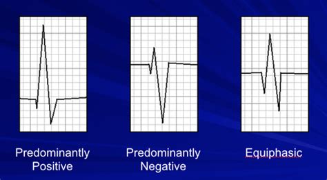 Electrocardiogram Flashcards Quizlet