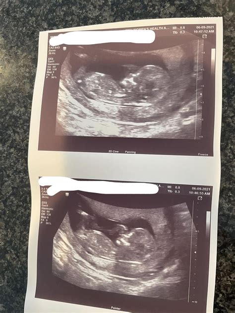 NT Scan Today Any Gender Guesses BabyCenter