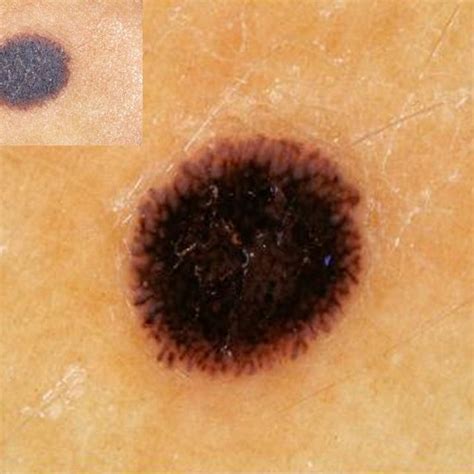 Clinical And Dermoscopic Typical Features Of Pigmented Spitz Nevus
