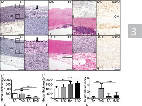 Figure 1 From Ascending Aorta Dilation In Association With Bicuspid