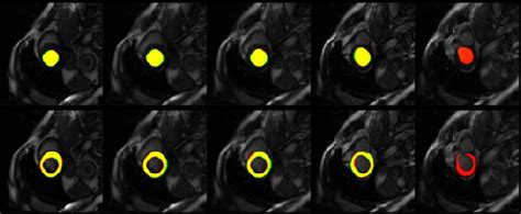 Figure 4 From Left And Right Ventricular Segmentation Based On 3d
