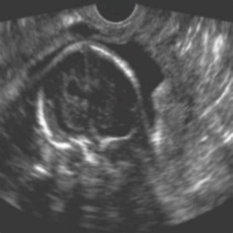 Class Intracranial Tumor Roboflow Universe Search