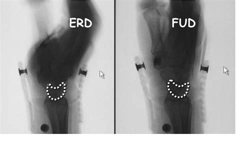 Figure 10 From Dart Splint An Innovative Orthosis That Can Be Integrated Into A Scapho Lunate