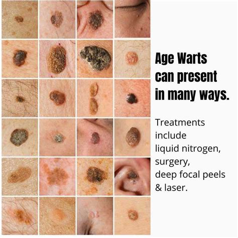 Seborrheic Keratosis Seborrheic Keratosis Symptoms Causes Artofit
