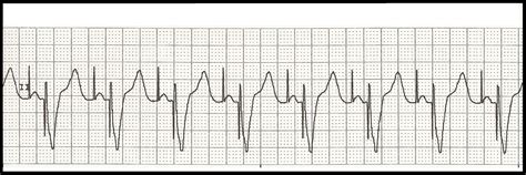 Ekg Rhythm Strip Quiz 100 Paced Rhythms