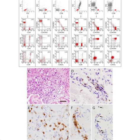 Immunophenotyping Of Lymphocytes In The Csf And Peripheral Blood And