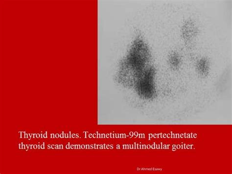 Thyriod Gland Imaging Part 5 Molecular Imaging Nuclear Imaging Spect